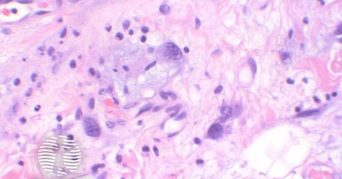 Myxoid liposarcoma pathology image