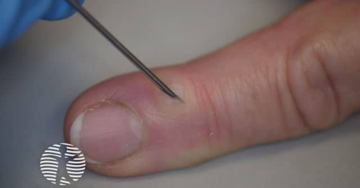 Digital Myxoid Cyst Image