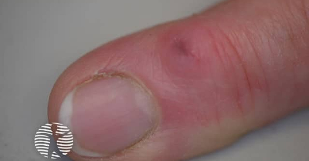 Digital myxoid cyst image