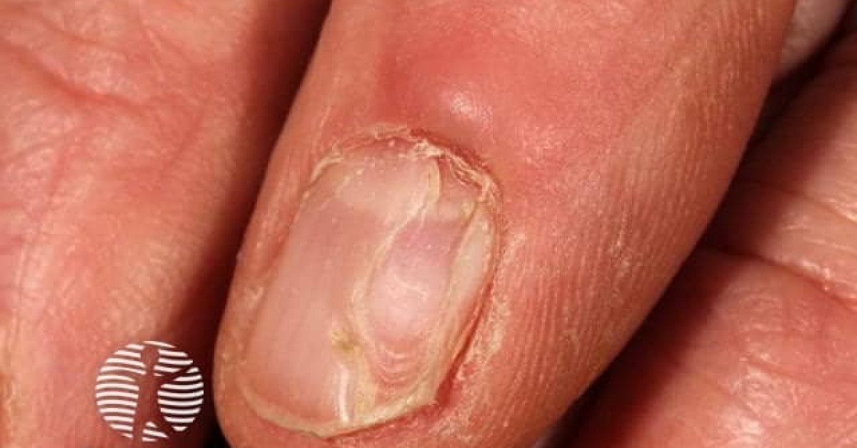 Digital myxoid cyst image