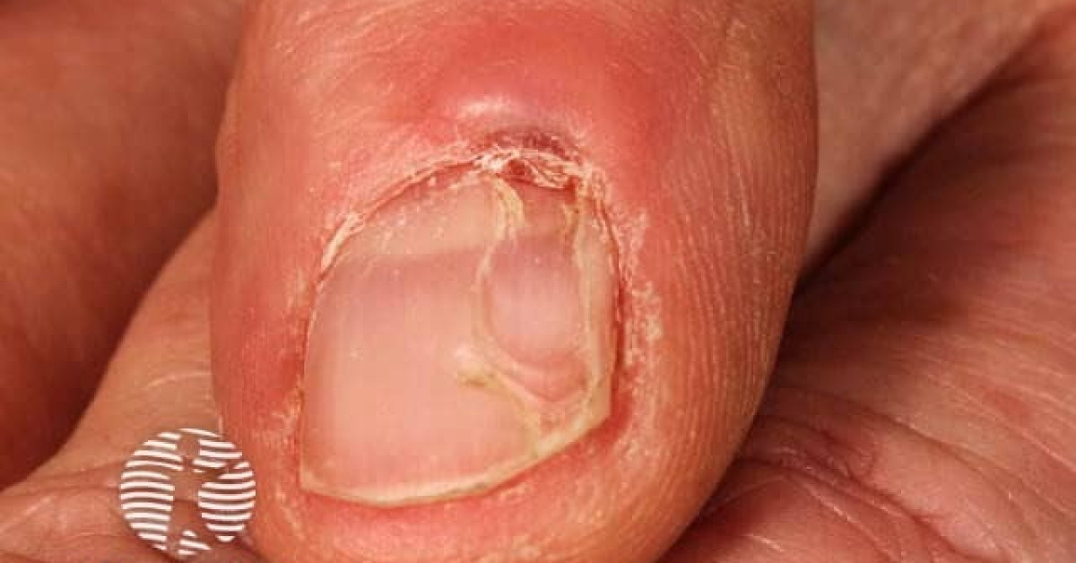Digital Myxoid Cyst Image