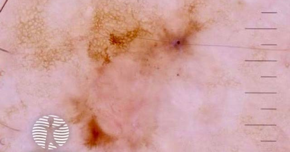 Nodular basal cell carcinoma dermoscopy image
