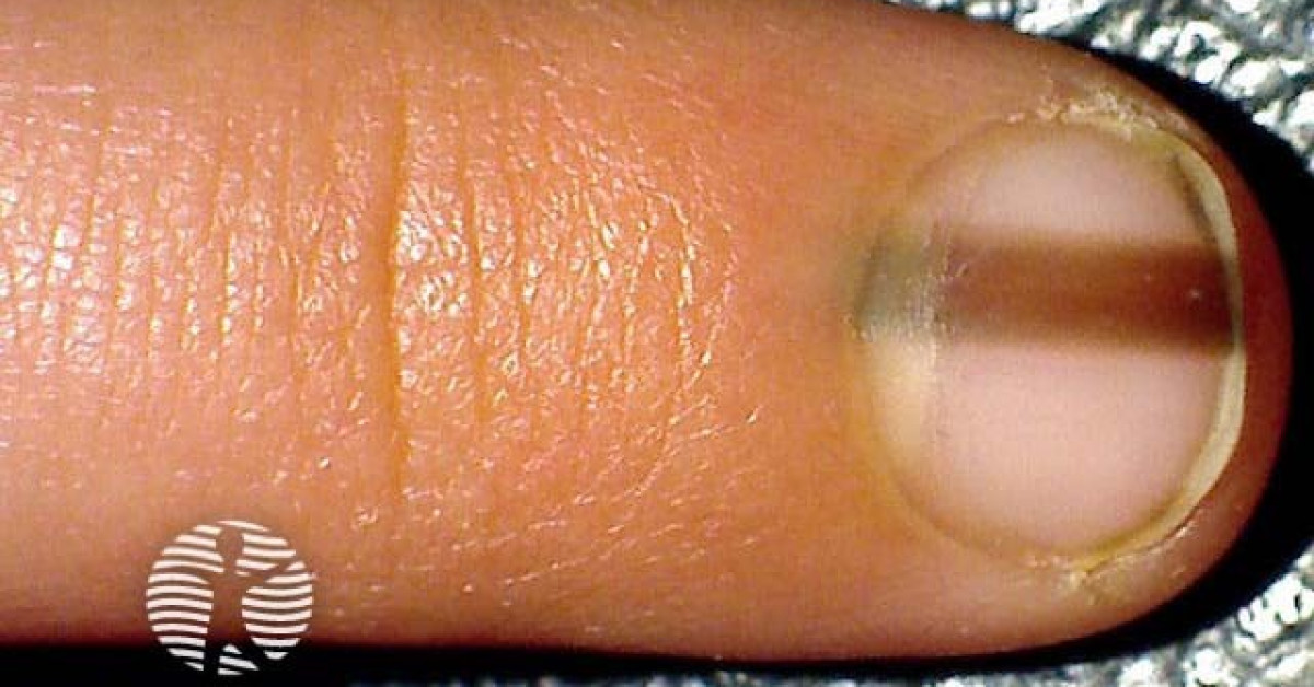 Naevus, fingernail image