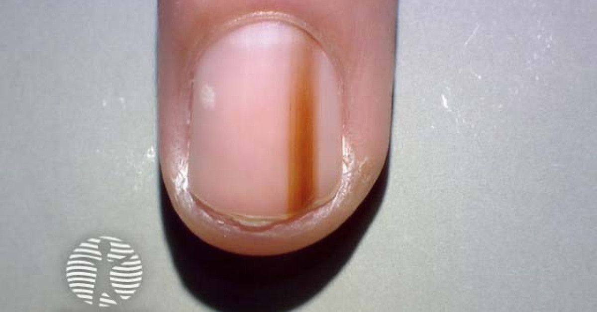 Naevus, nail image