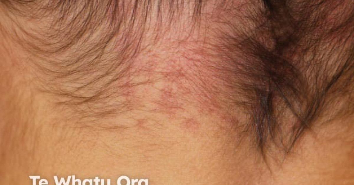 Naevus simplex image