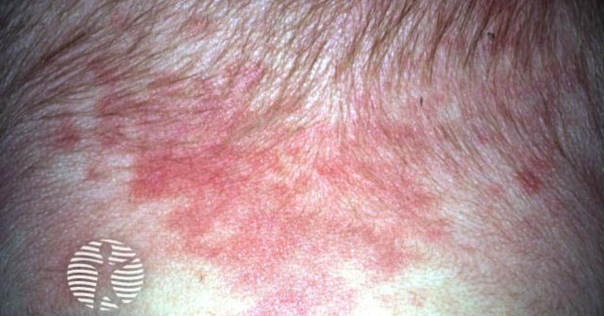 Naevus simplex image