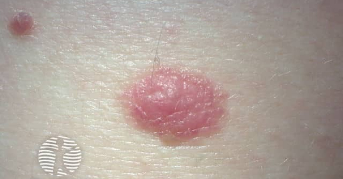 Pink dermal naevus image