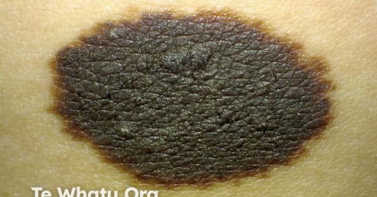 Melanocytic naevus image