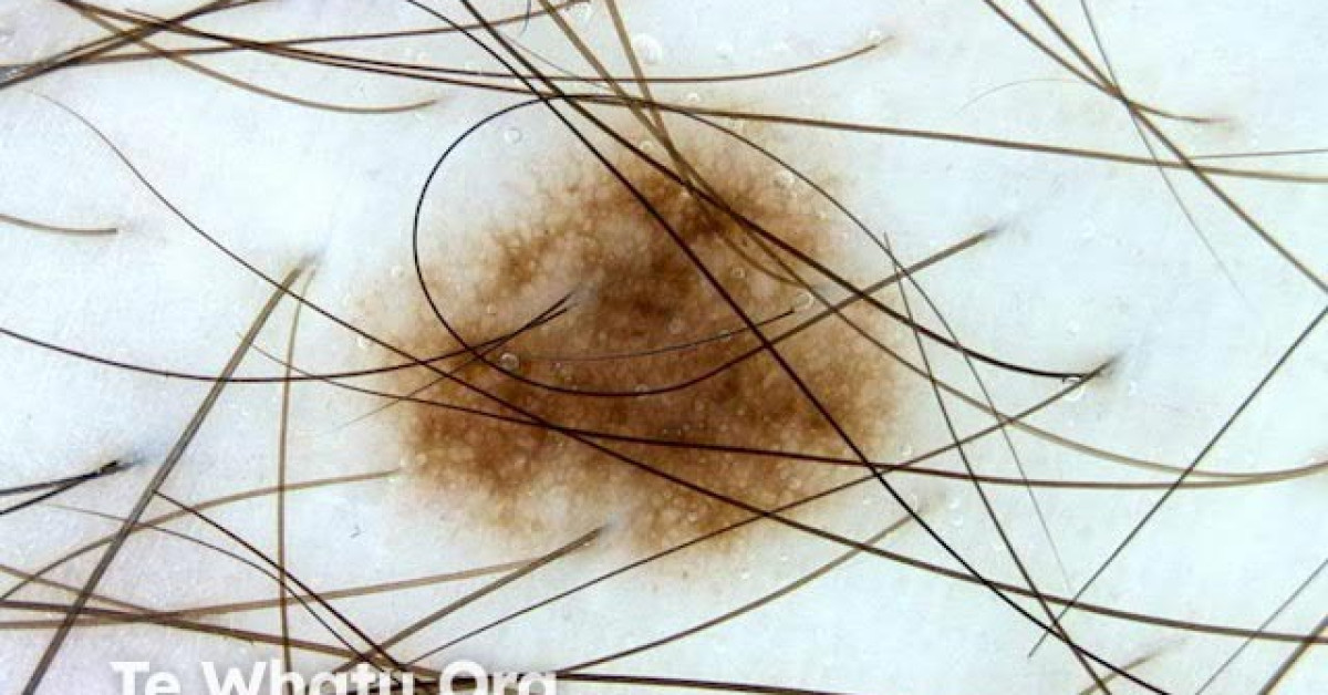 Naevus, skin type 1, dermoscopy image