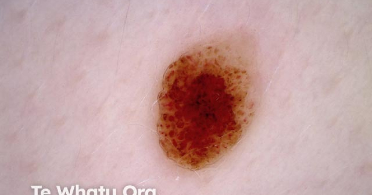Naevus, skin type 1, dermoscopy 1 image