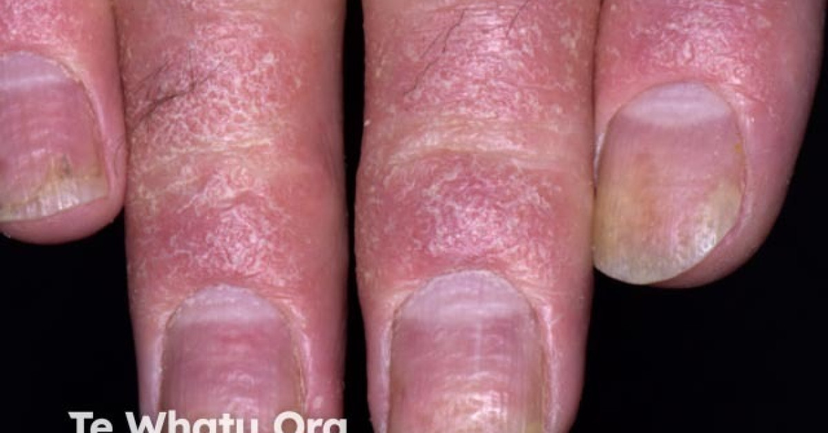 Nail psoriasis image
