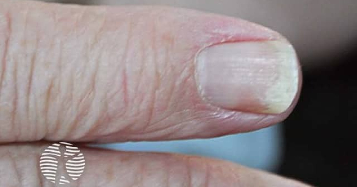 Nail psoriasis image