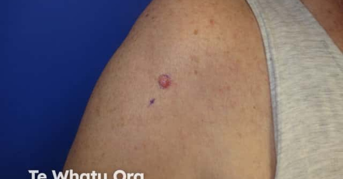 Nodular Basal Cell Carcinoma Arm Image