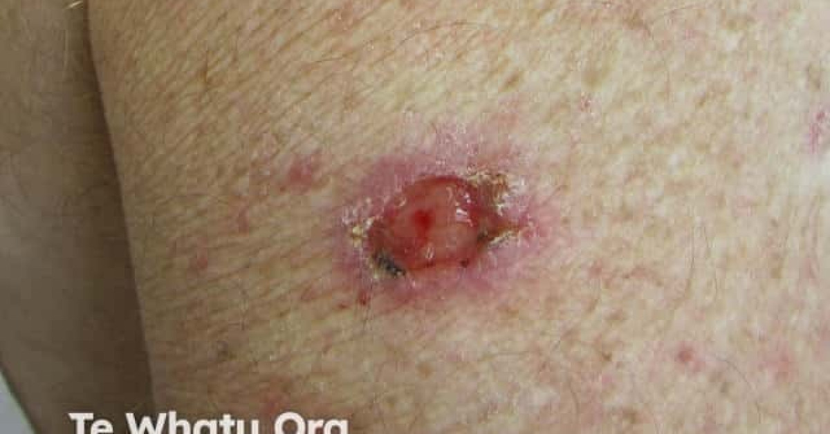 Nodular basal cell carcinoma, arm image