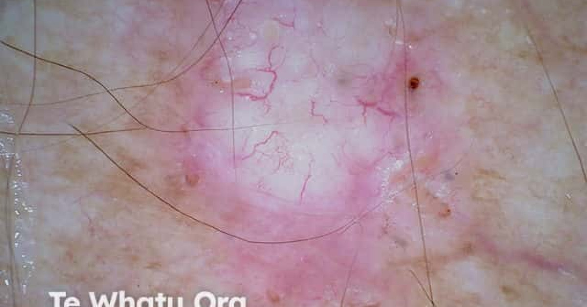 Nodular basal cell carcinoma dermoscopy image