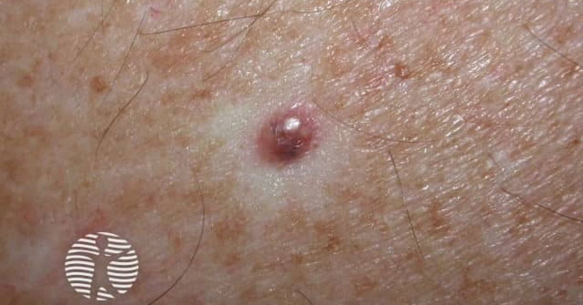 Nodular basal cell carcinoma, leg image