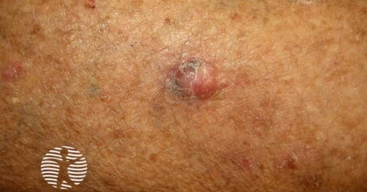 Nodular basal cell carcinoma, leg image