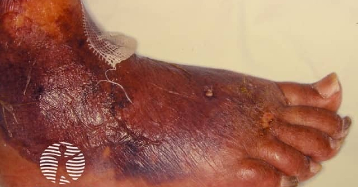 Necrotising fasciitis image