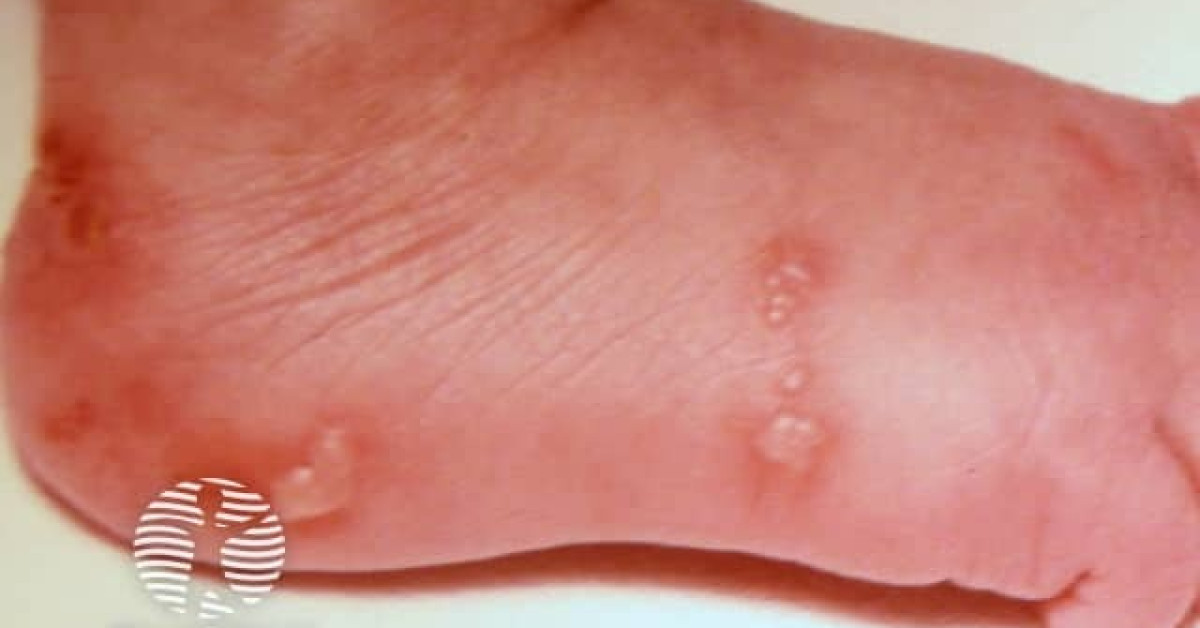 Neonatal herpes simplex2 image