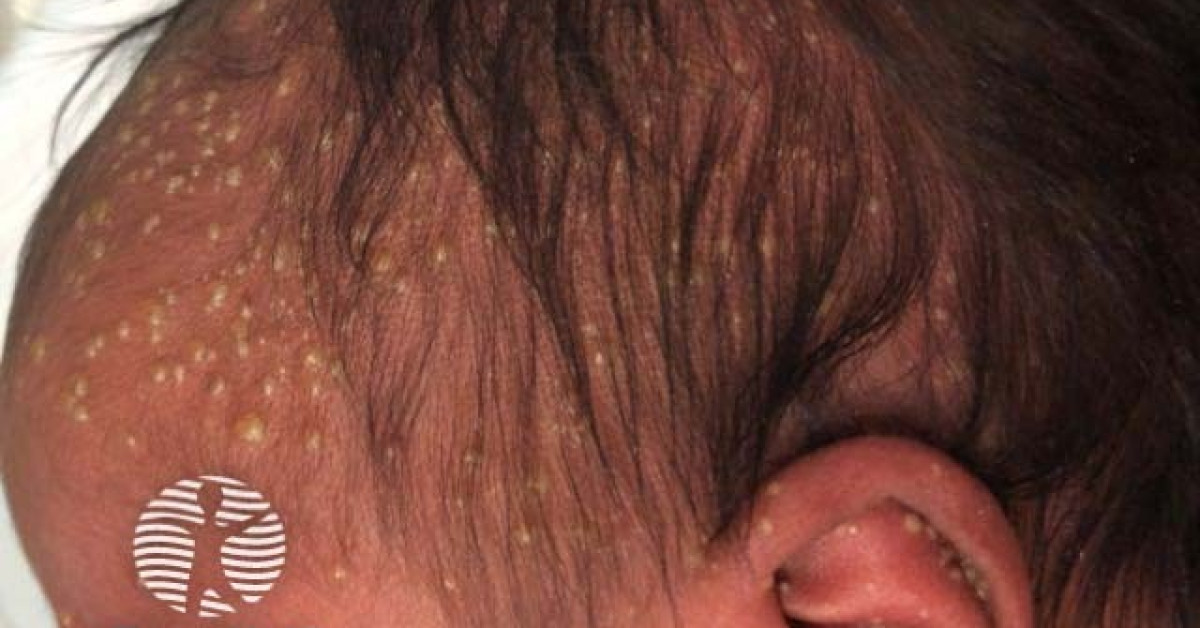 Transient neonatal pustular melanosis image