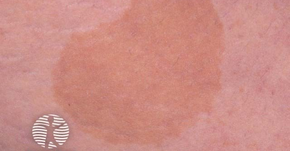 Cafe au lait macule of neurofibromatosis image