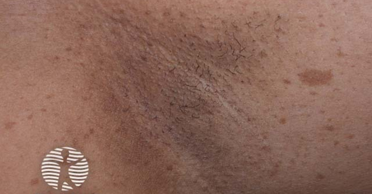 Axillary freckling in neurofibromatosis image