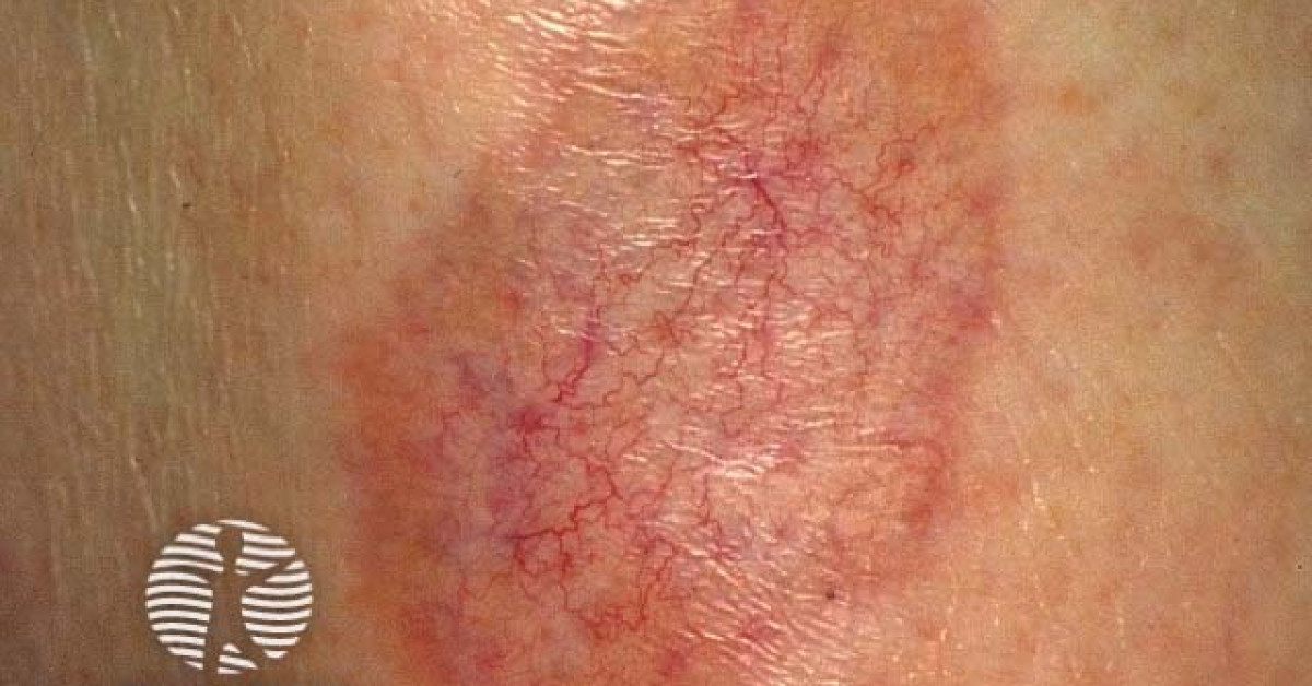 Necrobiosis lipoidica image