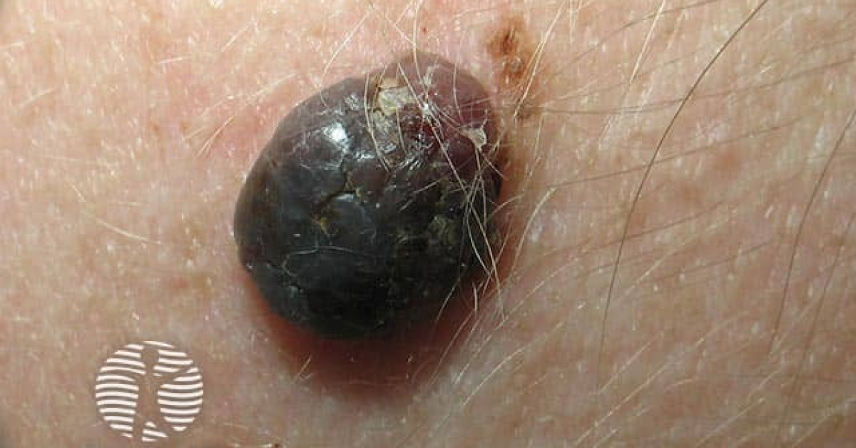 Nodular melanoma image