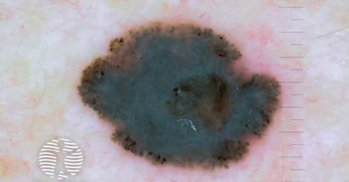 Dermoscopy of nodular melanoma Breslow 0.8 mm image