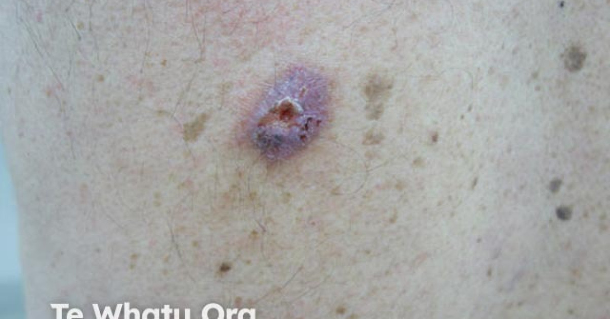 Nodular basal cell carcinoma image