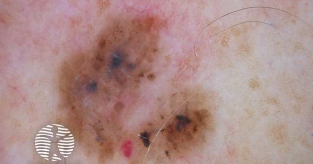 Nodular basal cell carcinoma 2 dermoscopic image