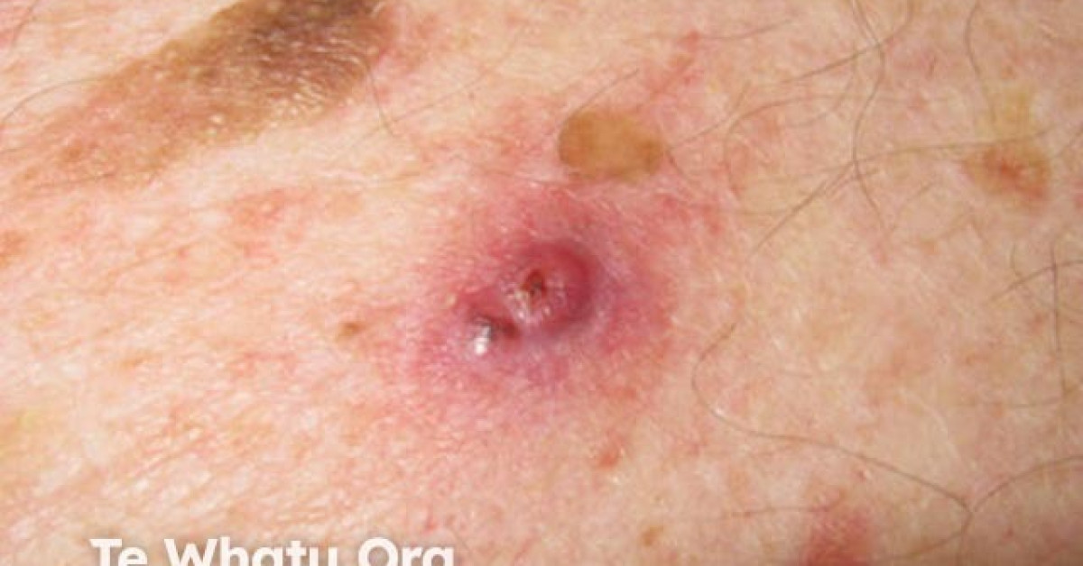 Nodular basal cell carcinoma image