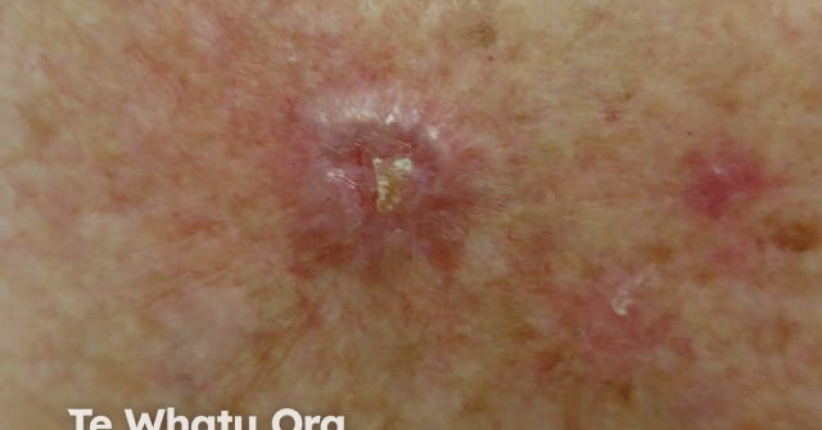 Nodular basal cell carcinoma 5 macro image