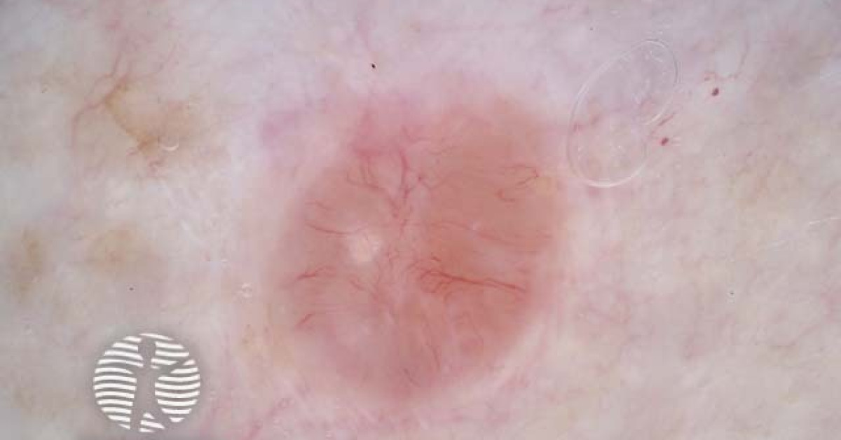 Nodular basal cell carcinoma dermoscopy image