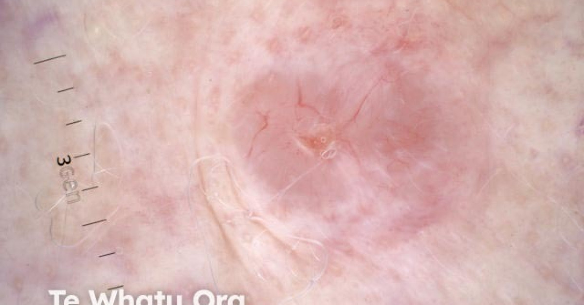 Nodular basal cell carcinoma dermoscopy image