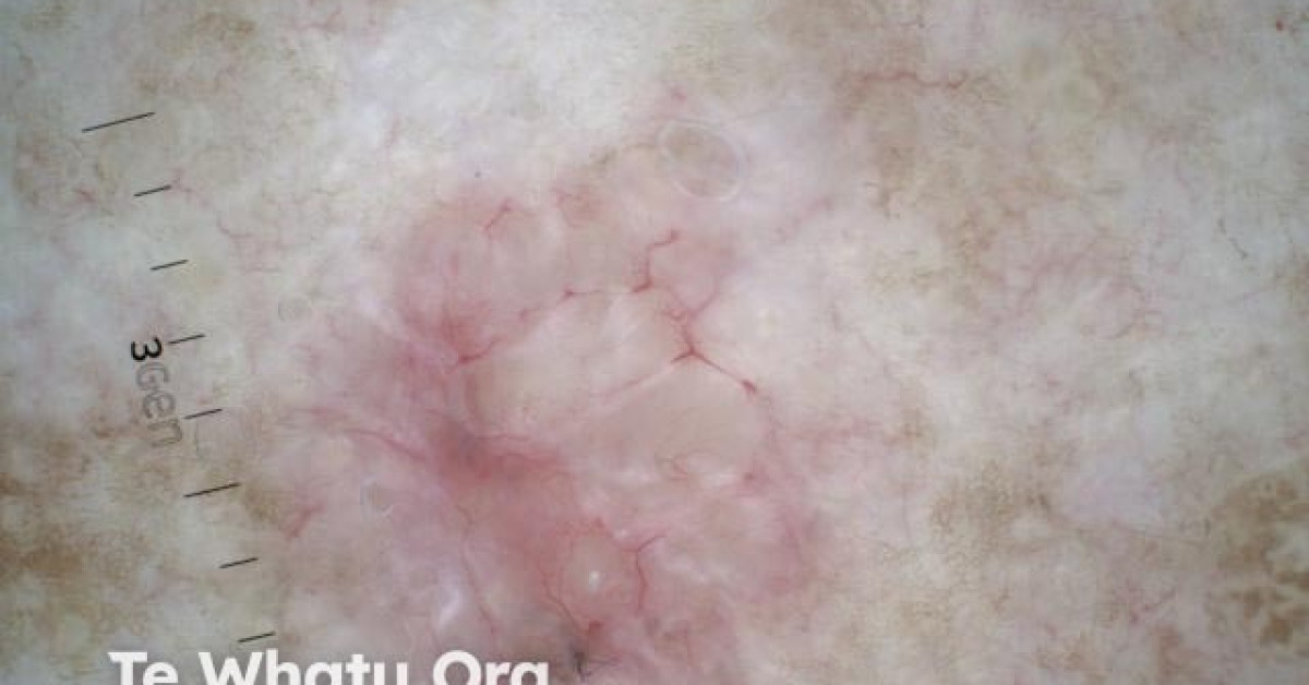 Nodular basal cell carcinoma dermoscopy image