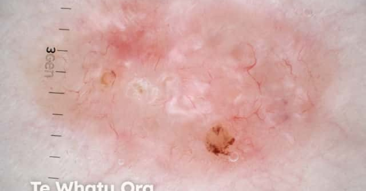 Nonpigmented nodular basal cell carcinoma dermoscopy image