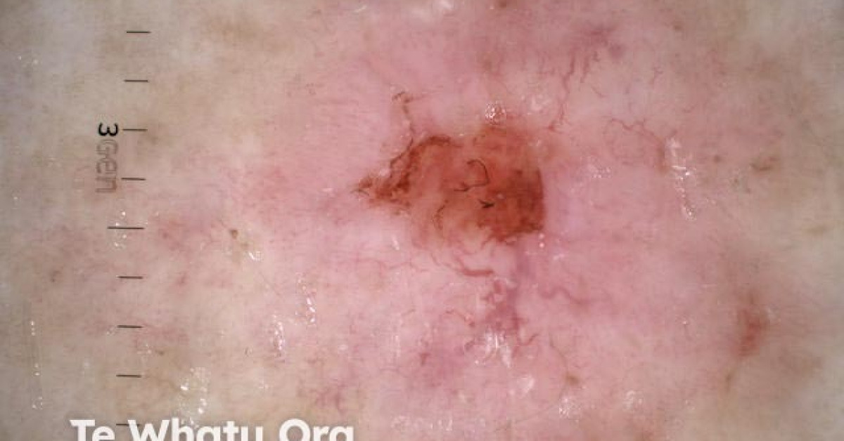 Nodular basal cell carcinoma dermoscopy image