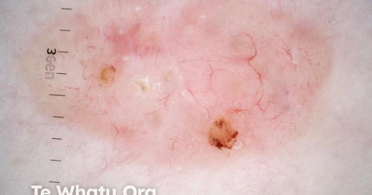 Dermnet® Nodular Basal Cell Carcinoma Nonpolarised Dermoscopy View Image