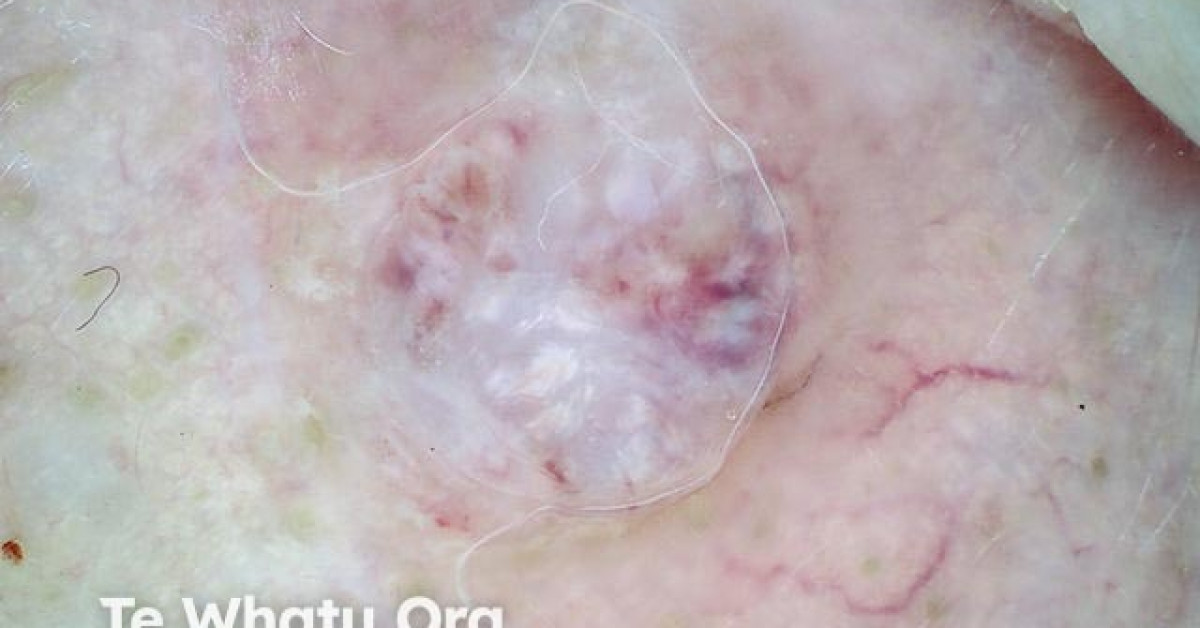 Nodular basal cell carcinoma, polarised dermoscopy view image