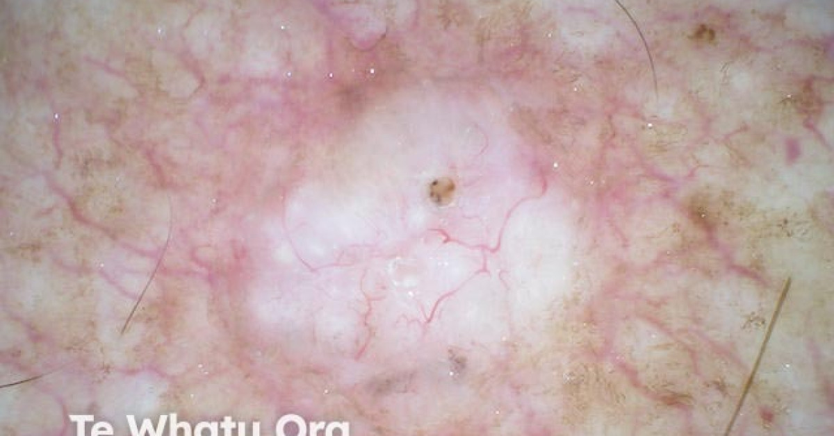 Nodular basal cell carcinoma, nonpolarised dermoscopy view image