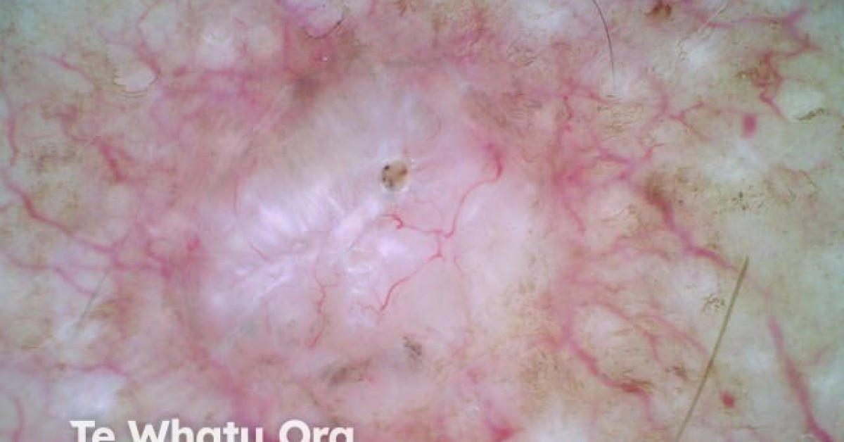 Nodular basal cell carcinoma, polarised dermoscopy view image