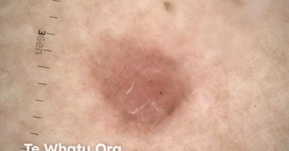 Nodular basal cell carcinoma dermoscopy image
