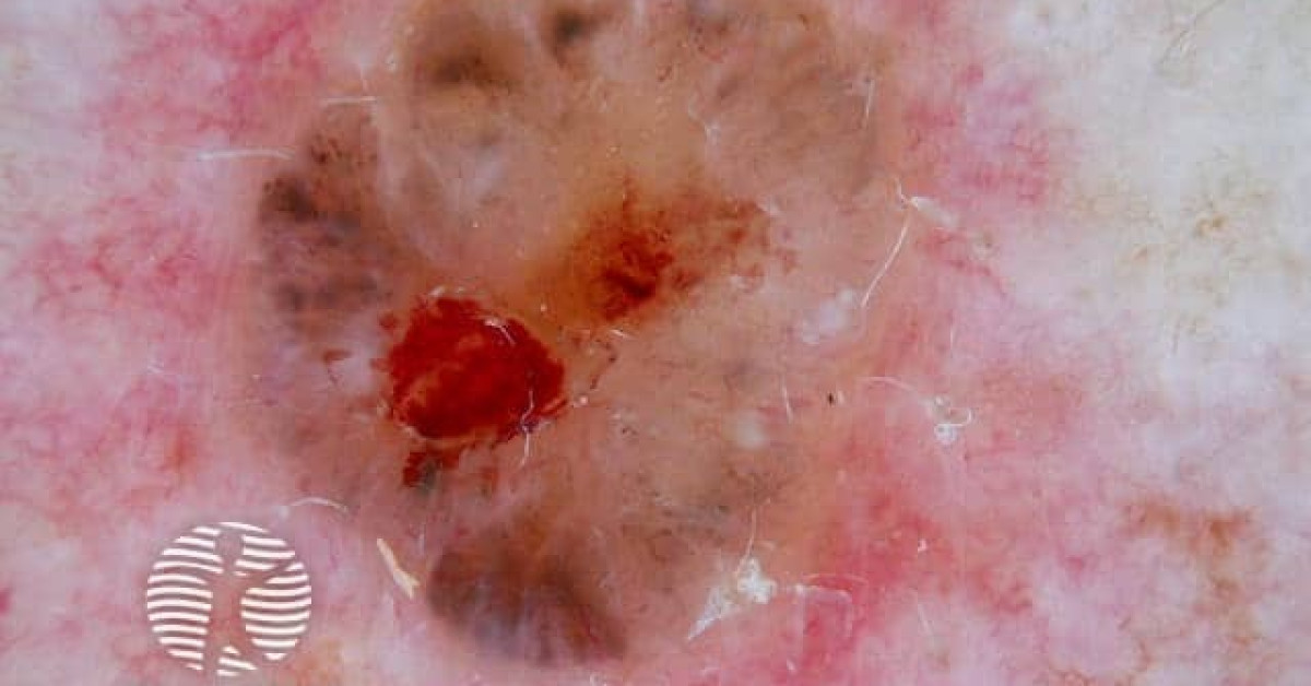 Nodular basal cell carcinoma dermoscopy image