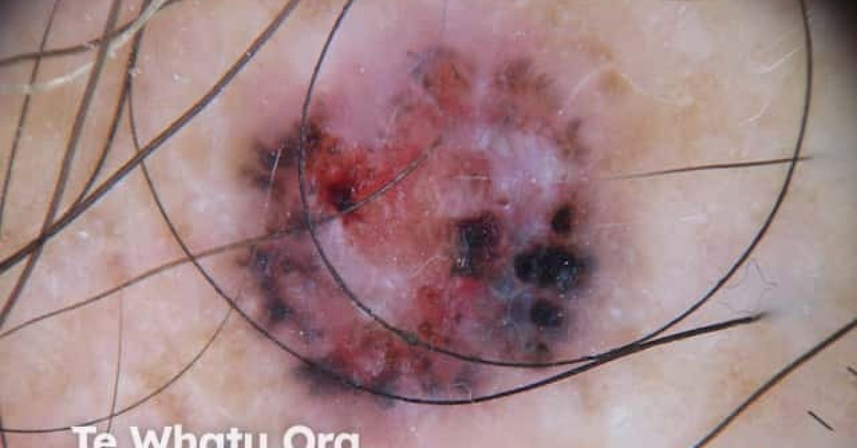 Nodular basal cell carcinoma dermoscopy image