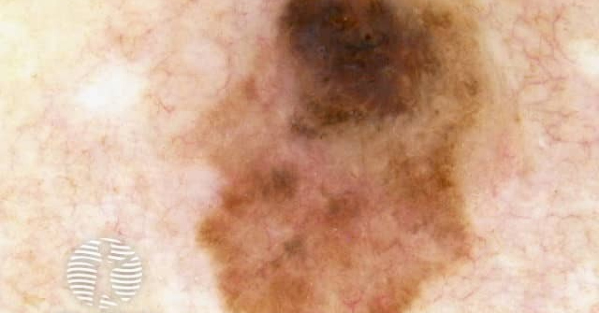 Dermoscopy of nodular melanoma arising within a superficial spreading ...