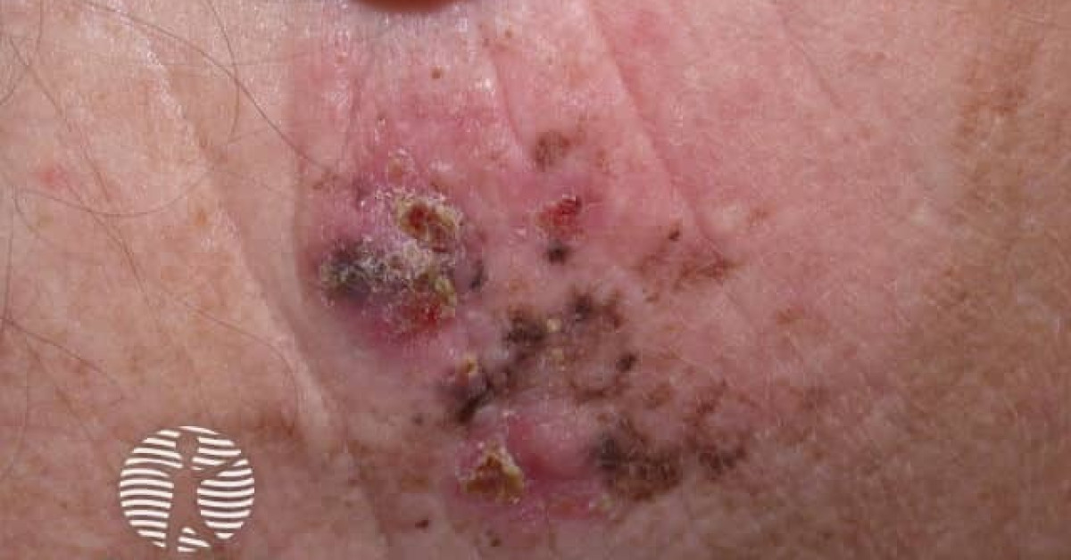 Nodular melanoma 7.5 mm arising in lentigo maligna meldanoma image