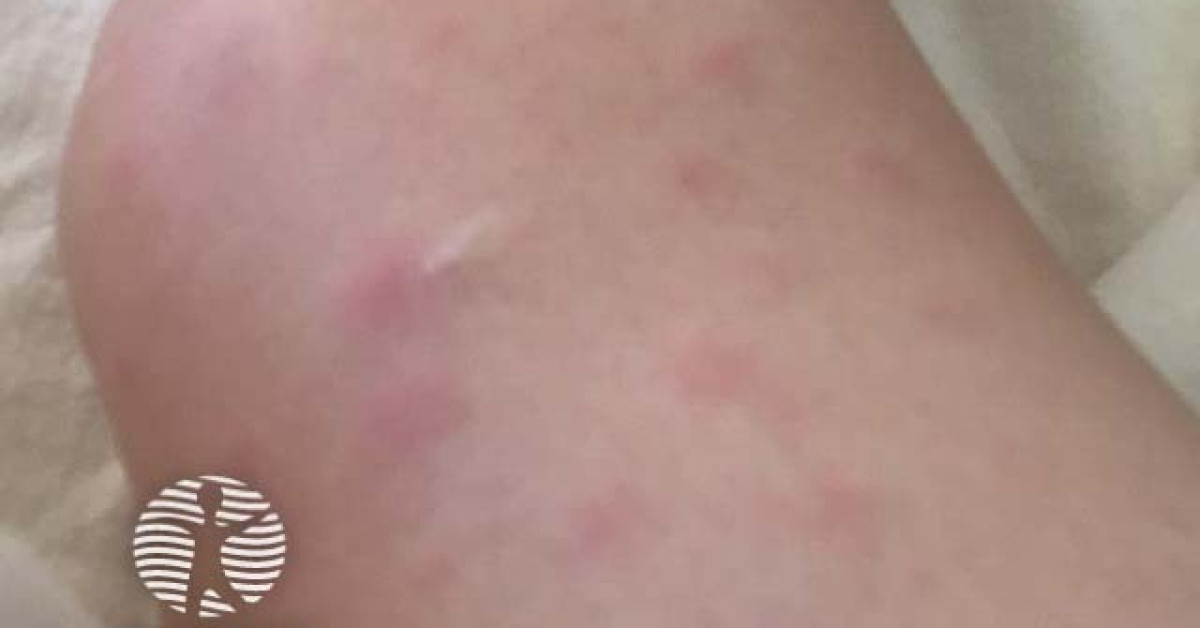 Nodular panniculitis image