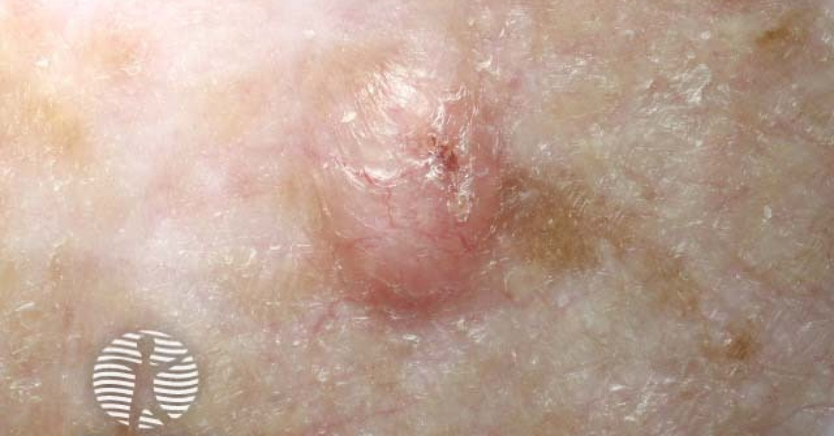 Nodulocystic basal cell carcinoma image