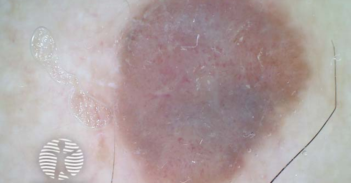 Nodular amelanotic melanoma nonpolarised dermoscopy view image